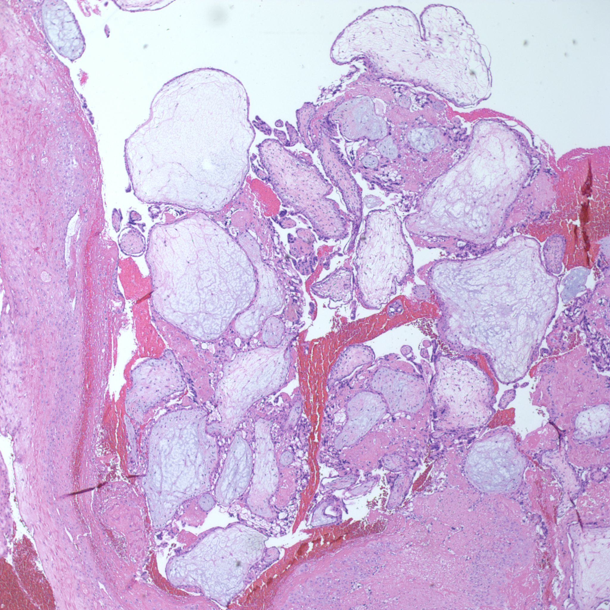 Complete Hydatidiform Mole | HistoCloud