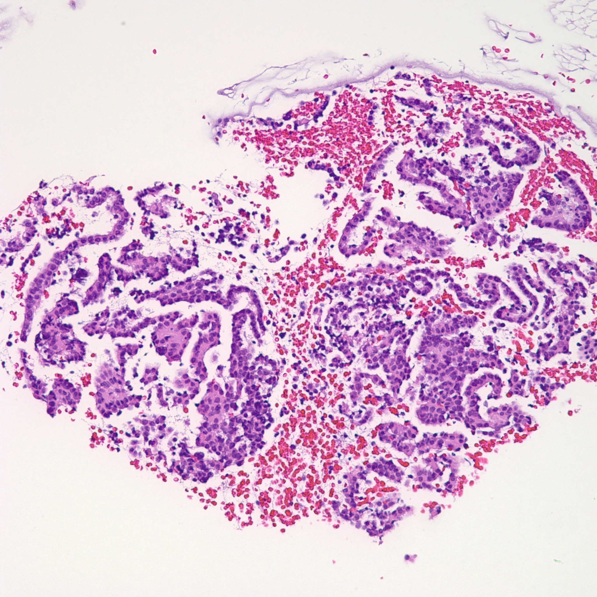 Placental Site Nodule – HistoCloud